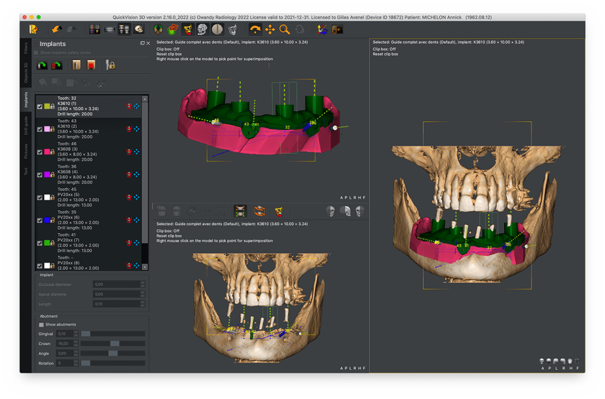 Caméra Owandy-IOS pour la prise d'empreinte dentaire